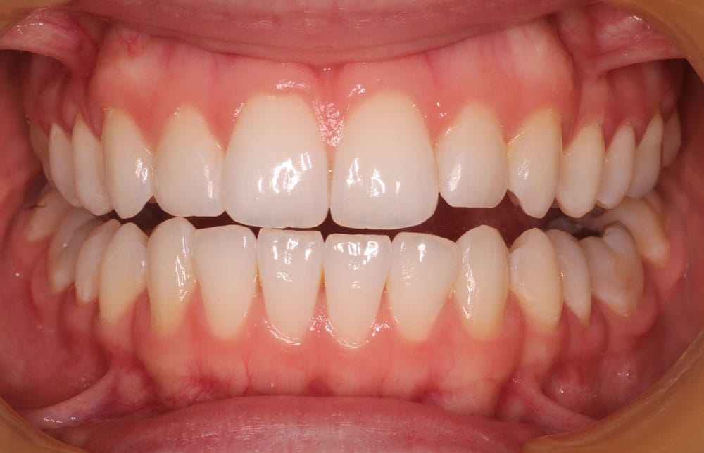 Smile Gallery - Dentist Dewsbury