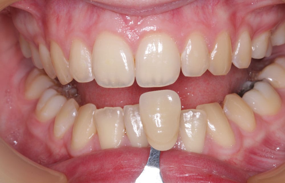 Smile Gallery - Dentist Dewsbury